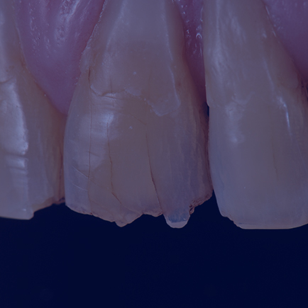 The Toothwear Course - Indigodent